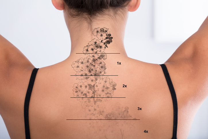 Tattoo Removal - West Dermatology
