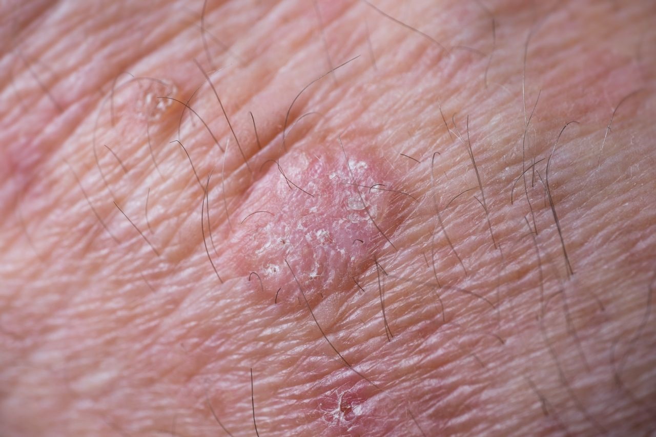 Actinic Keratoses